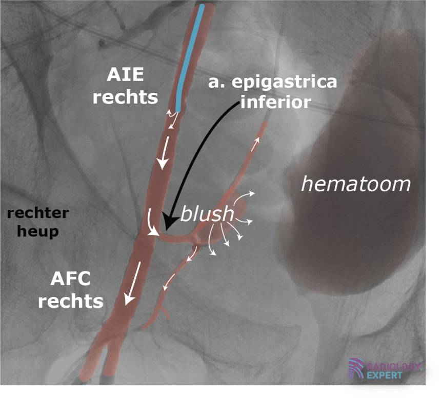 Vasculaire Interventie