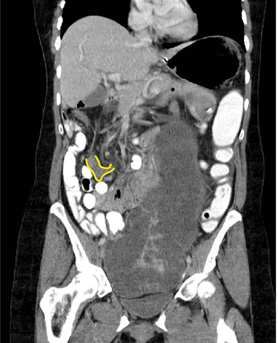 Abdominal X-ray
