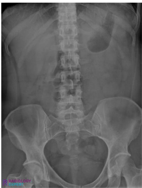 Abdominal X-ray