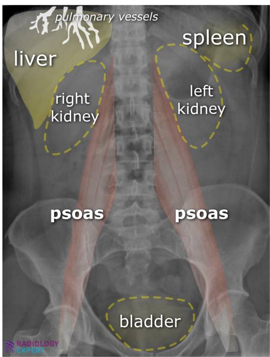 Abdominal X Ray