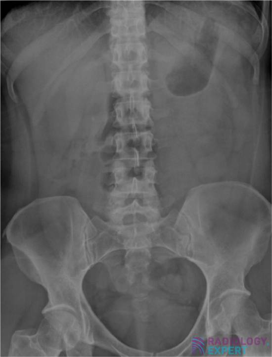 Abdominal X-ray