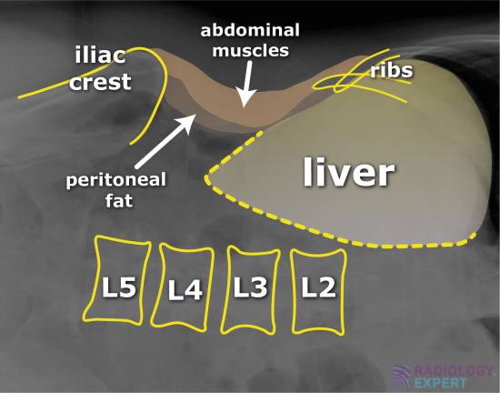 Abdominal X-ray