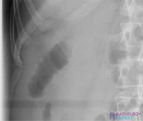 Abdominal X-ray