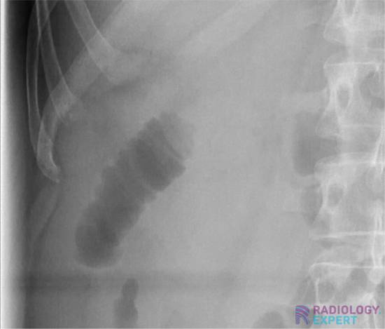 Abdominal X-ray