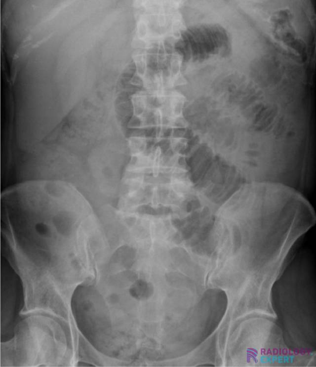 Abdominal X-ray