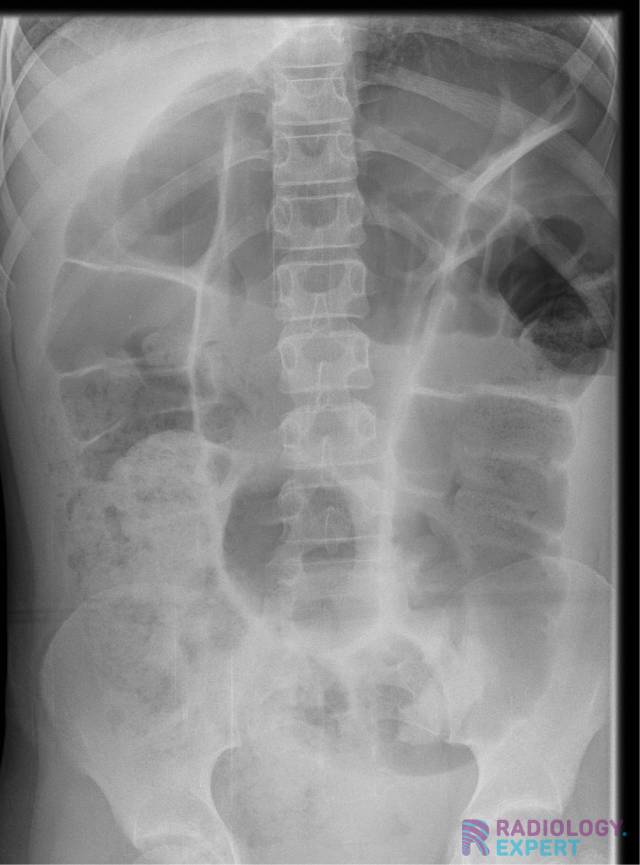 Abdominal X-ray