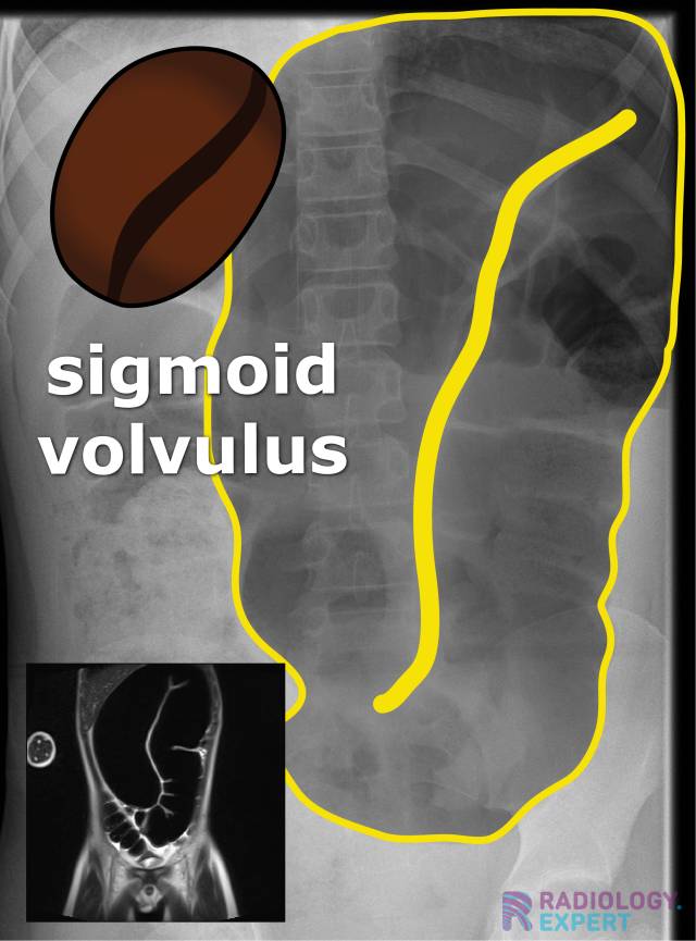 Sigmoid Volvulus Mri