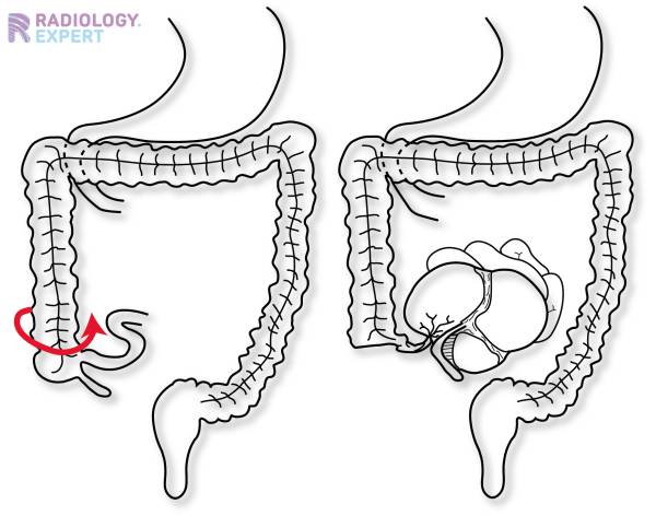 Cecal Volvulus Vs Sigmoid Volvulus