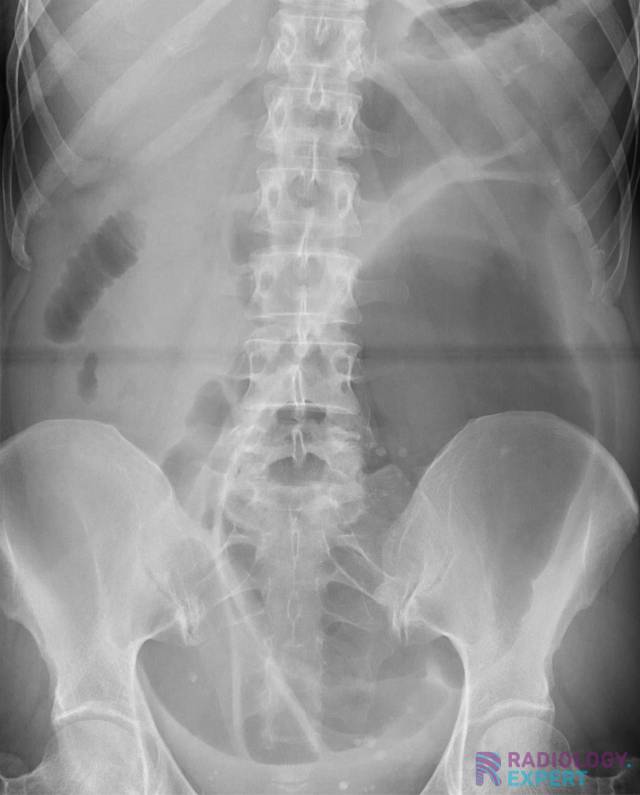 Abdominal X-ray
