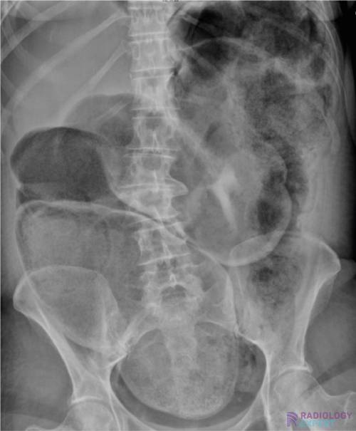 Abdominal X-ray