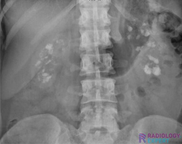 abdominal x rays