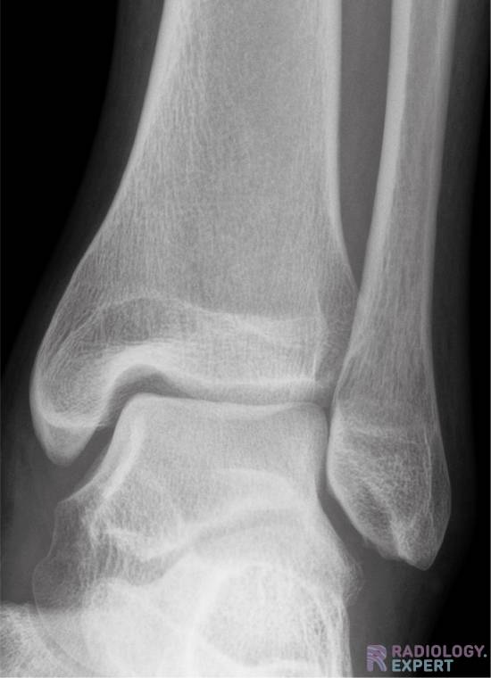 X Ankle