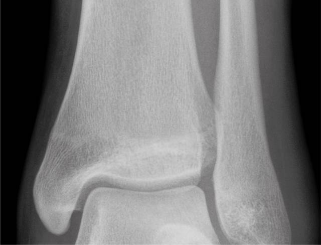 X Ray Ankle Ap Foot, Ankle, And Calf | Radiology Key