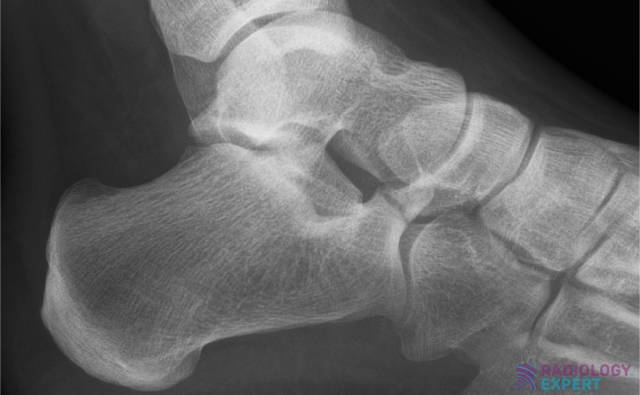 X-Ankle