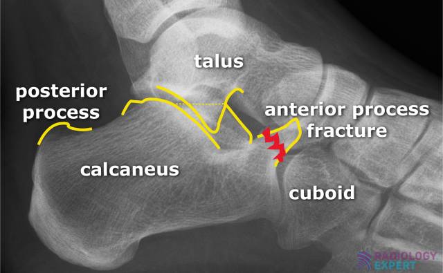 Anterior Process Calcaneus Acute Fracture Of The Anterior Process Of