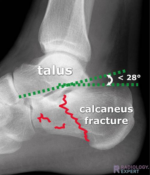 X-Ankle
