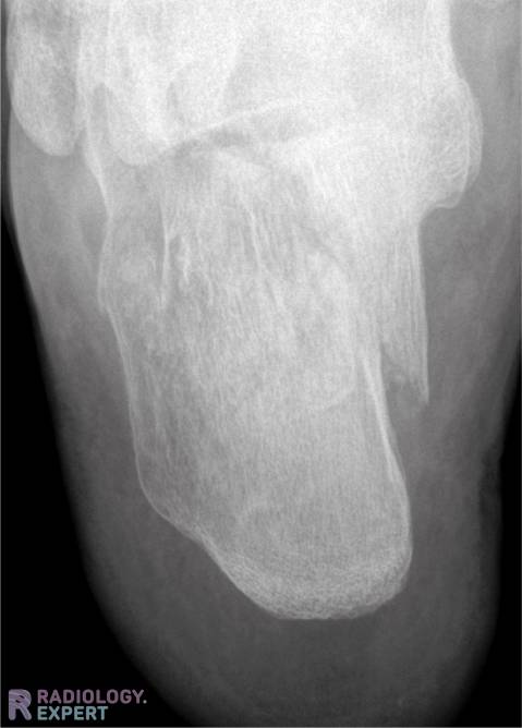 Calcaneus Fracture Axial View