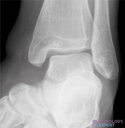 X-Ankle