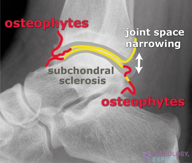 X-Ankle