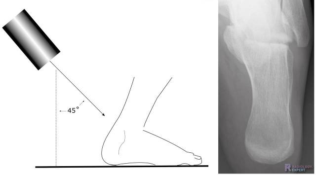 Enkel Reirtegning X Enkel