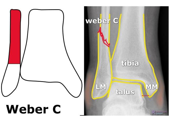 Enkel Reirtegning X Enkel