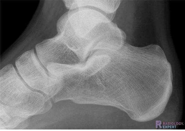 Enkel Reirtegning X Enkel