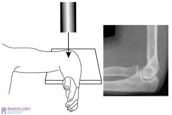 Xray Elbow Joint Anteroposterior And Lateral Views Of A Radiology In