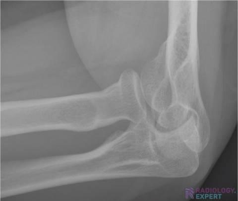 X Ray Elbow Normal Normal Elbow And Wrist Joints, X Ray Stock Photo