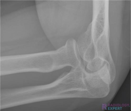 X-Elbow