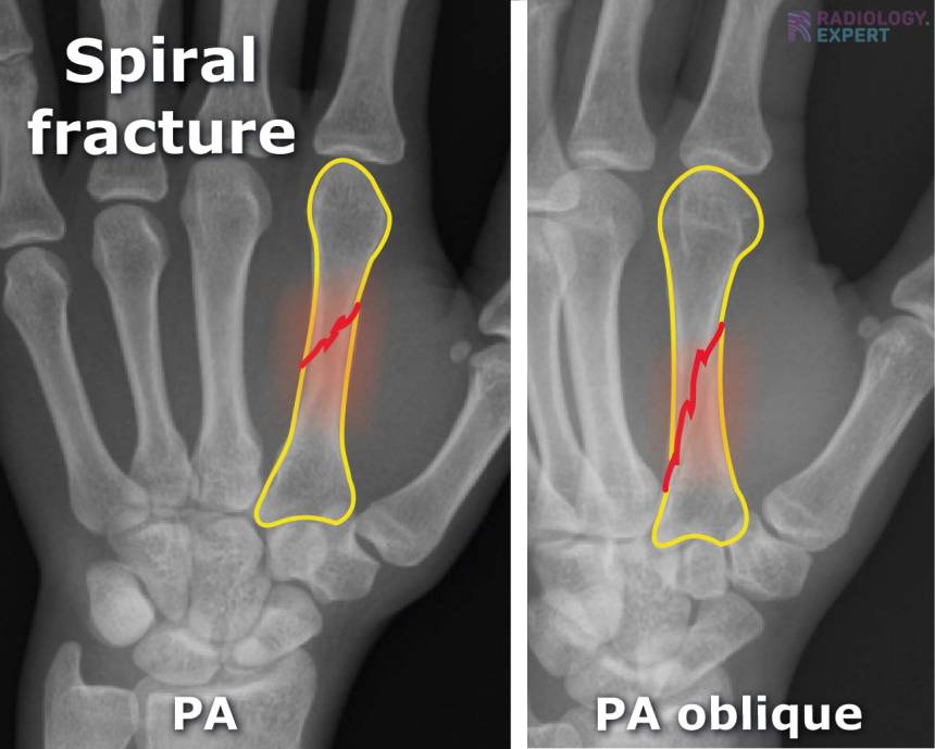 X-Hand