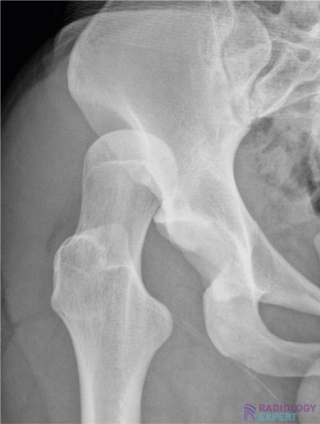 dashboard fracture radiology