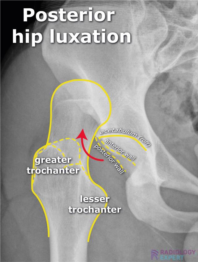 X-Hip