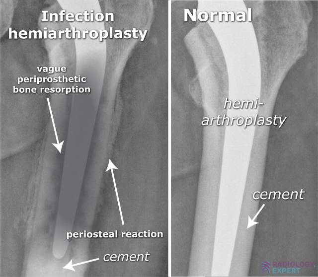 bone resorption x ray
