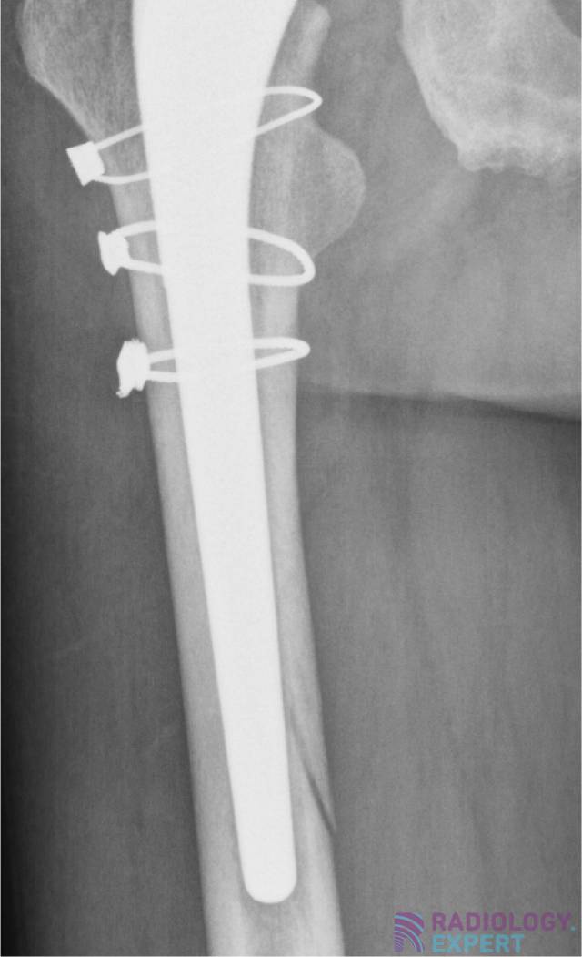 dashboard fracture radiology