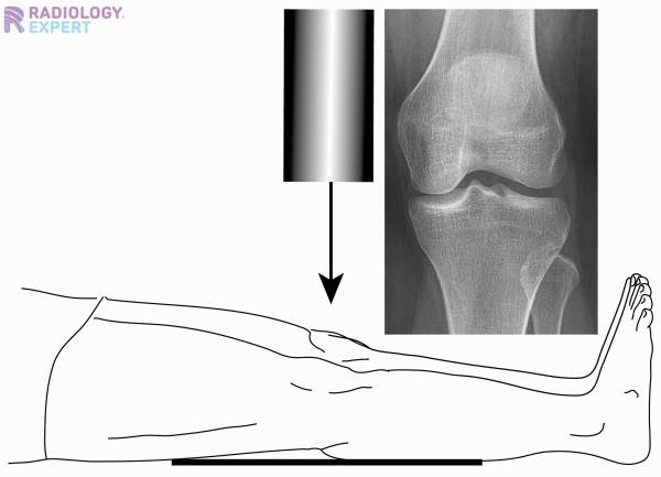 Intercondylar Notch View