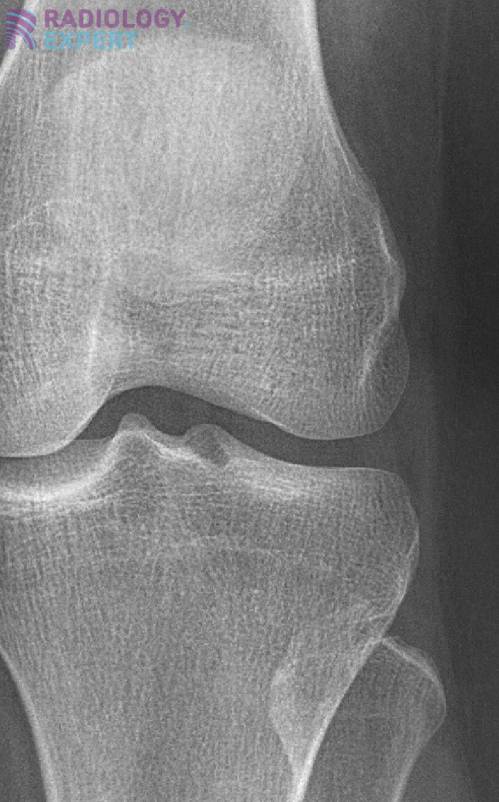 X-Knee