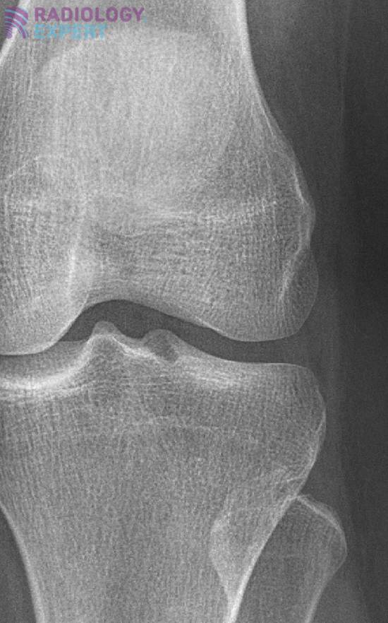 X-Knee