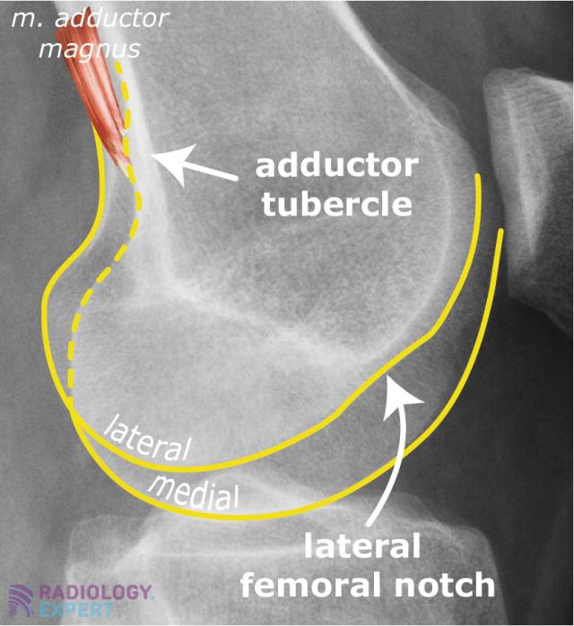 Adductor Tubercle Of Femur