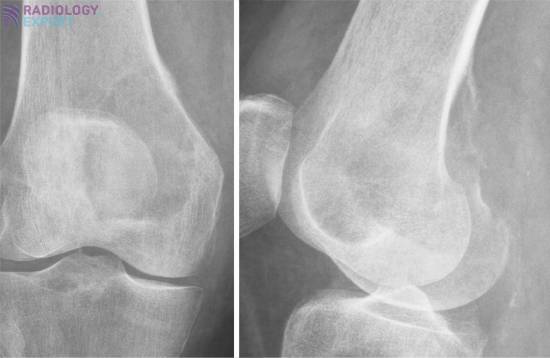 X-Knee