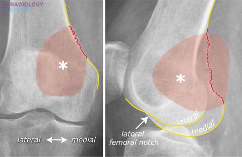 notch knee