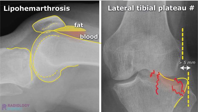 Tibial Plateau Fracture Xray