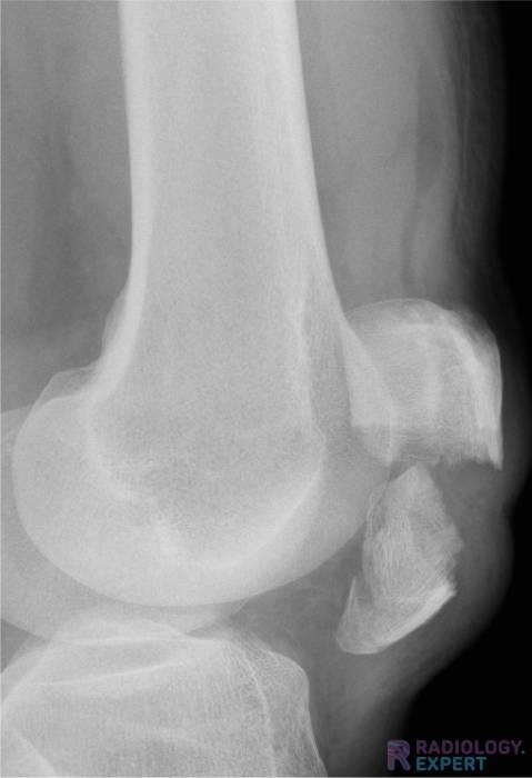 X Knee