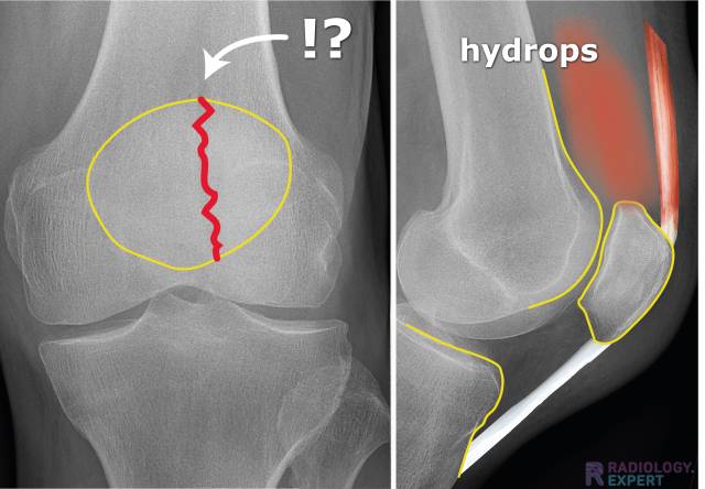 Xray Knee Aplateral Showing Fracture Patella Or Knee Cap A