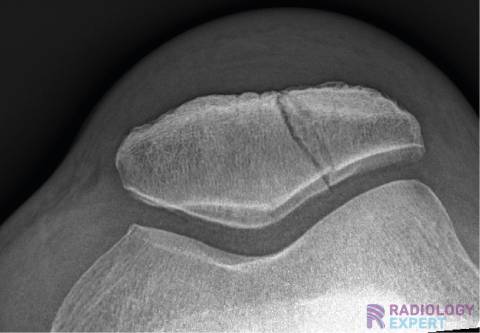 Patella Fracture Sunrise