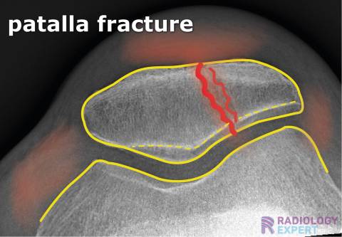 Patella Fracture Sunrise