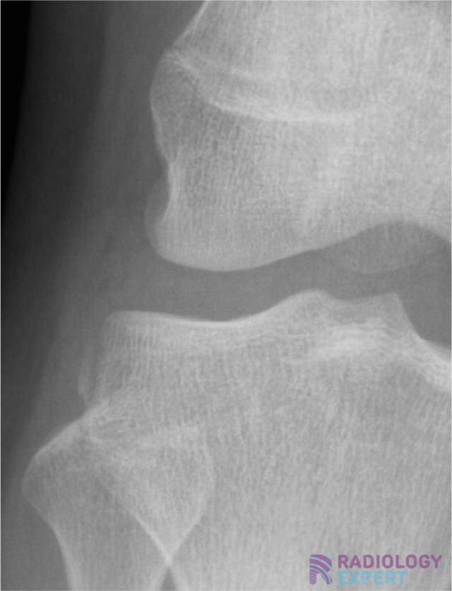 X-Knee