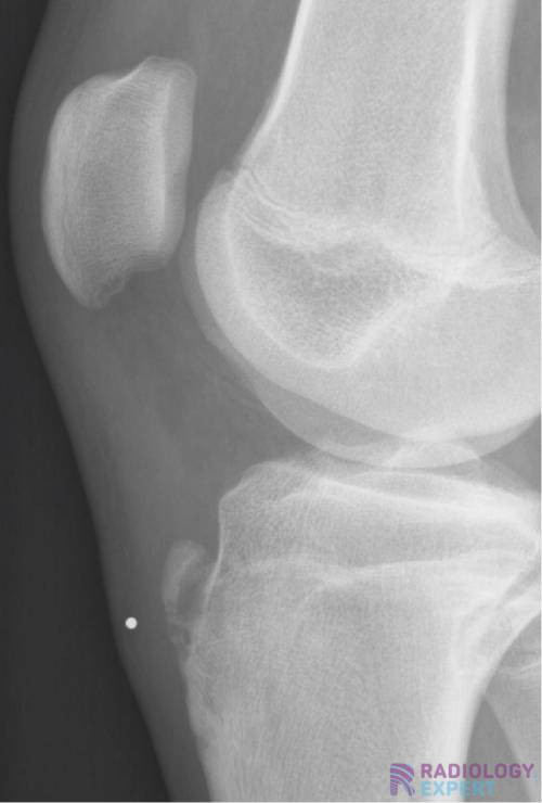X-Knee