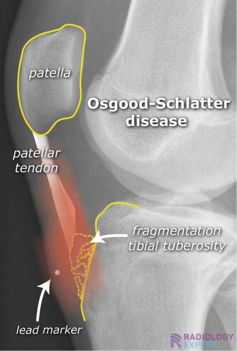 Osgood Schlatter X Ray X Ray Of My Son's Knee : R/Radiology