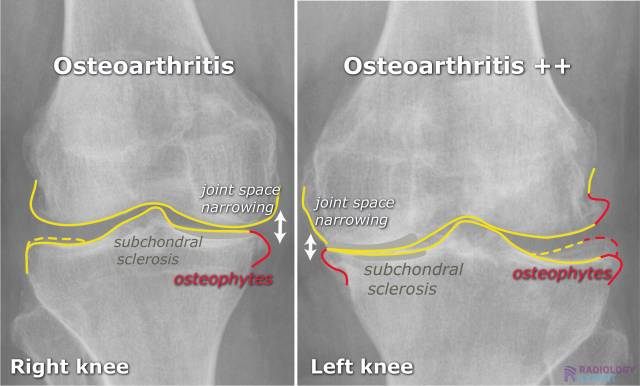 X-Knee