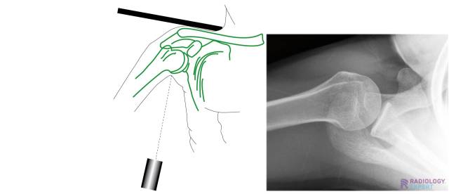 X Ray Shoulder